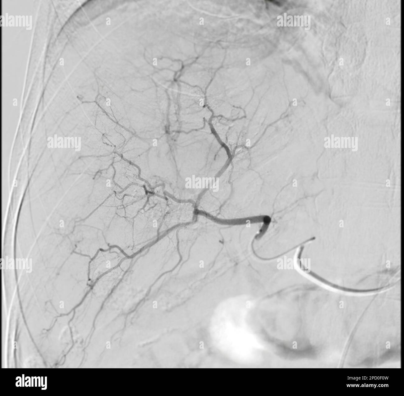 Imaging of TACE or Chemoembolization is a procedure that allows a dose ...