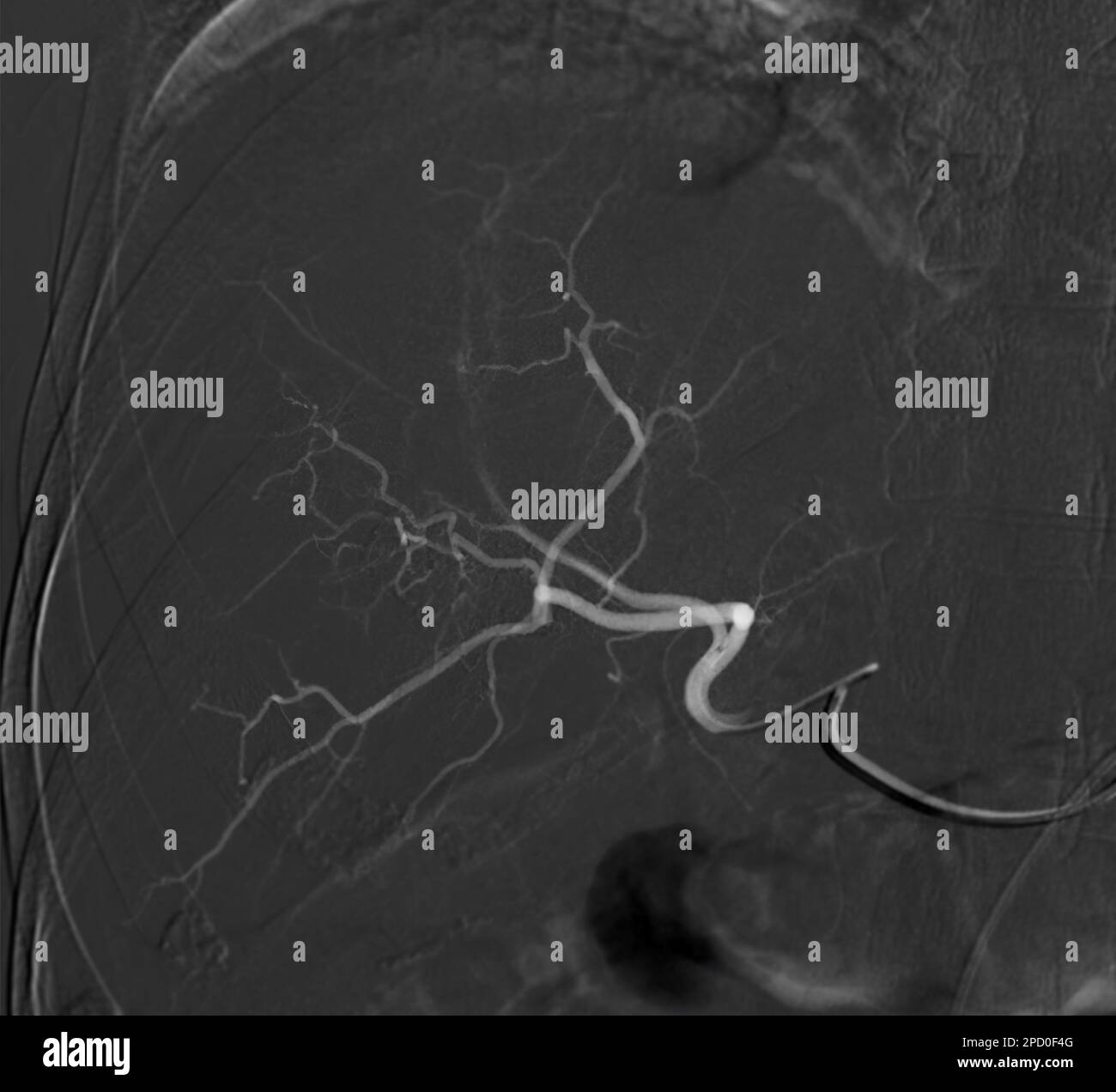 Imaging of TACE or Chemoembolization is a procedure that allows a dose ...
