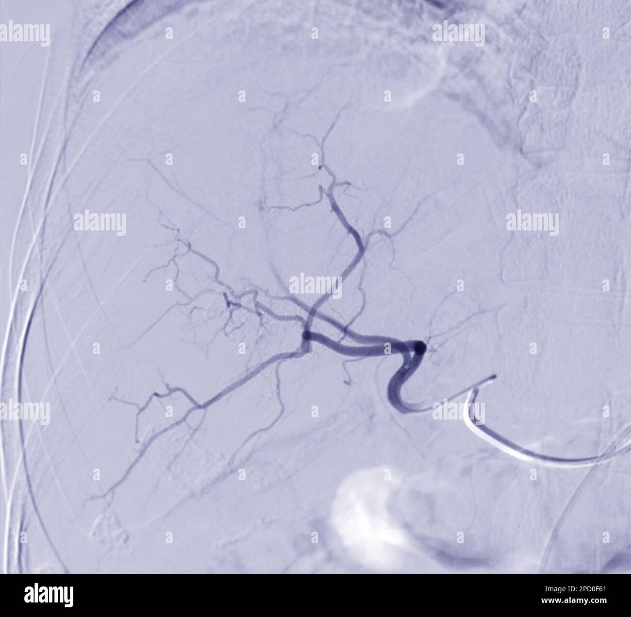 Imaging of TACE or Chemoembolization is a procedure that allows a dose ...