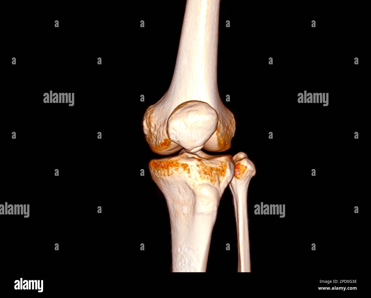 CT Scan of Knee joint 3D rendering Stock Photo - Alamy CT Scan of Knee joint 3D rendering Stock Photo - Alamy