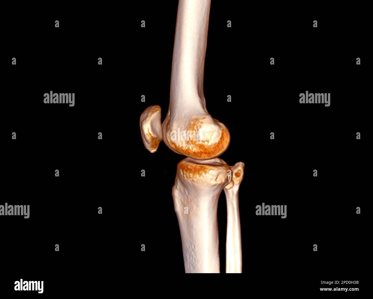 CT Scan of Knee joint 3D rendering Stock Photo - Alamy