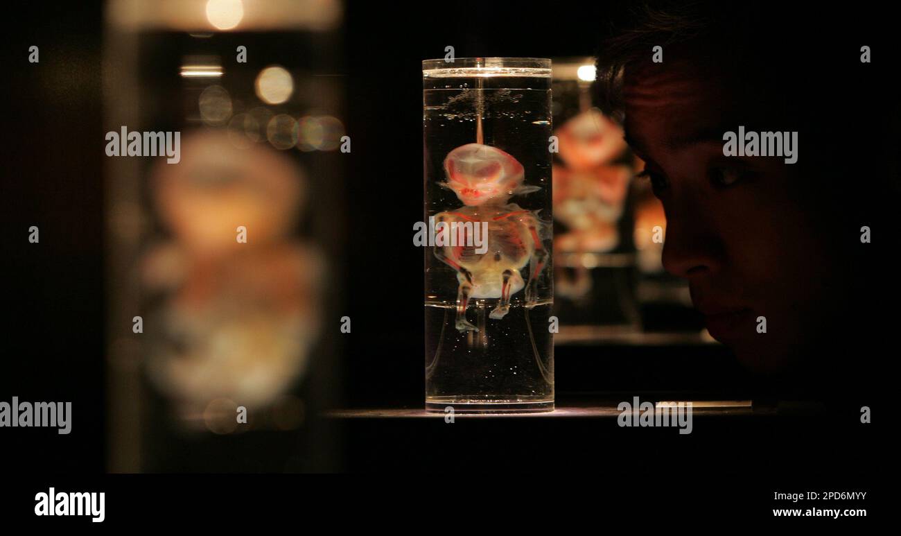 ** EDS NOTE GRAPHIC CONTENT ** A man studies a 20 week old foetus ...