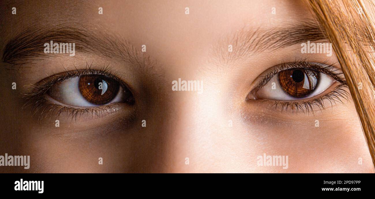 Strabismus. Close-up part child's face, eyes girl. Little patient ...