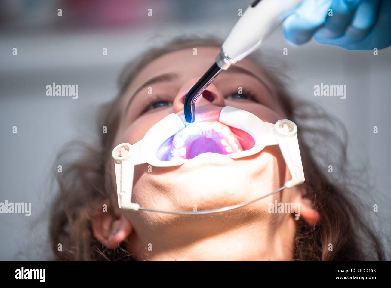 The dentist uses an ultraviolet lamp while fitting the girl with braces ...