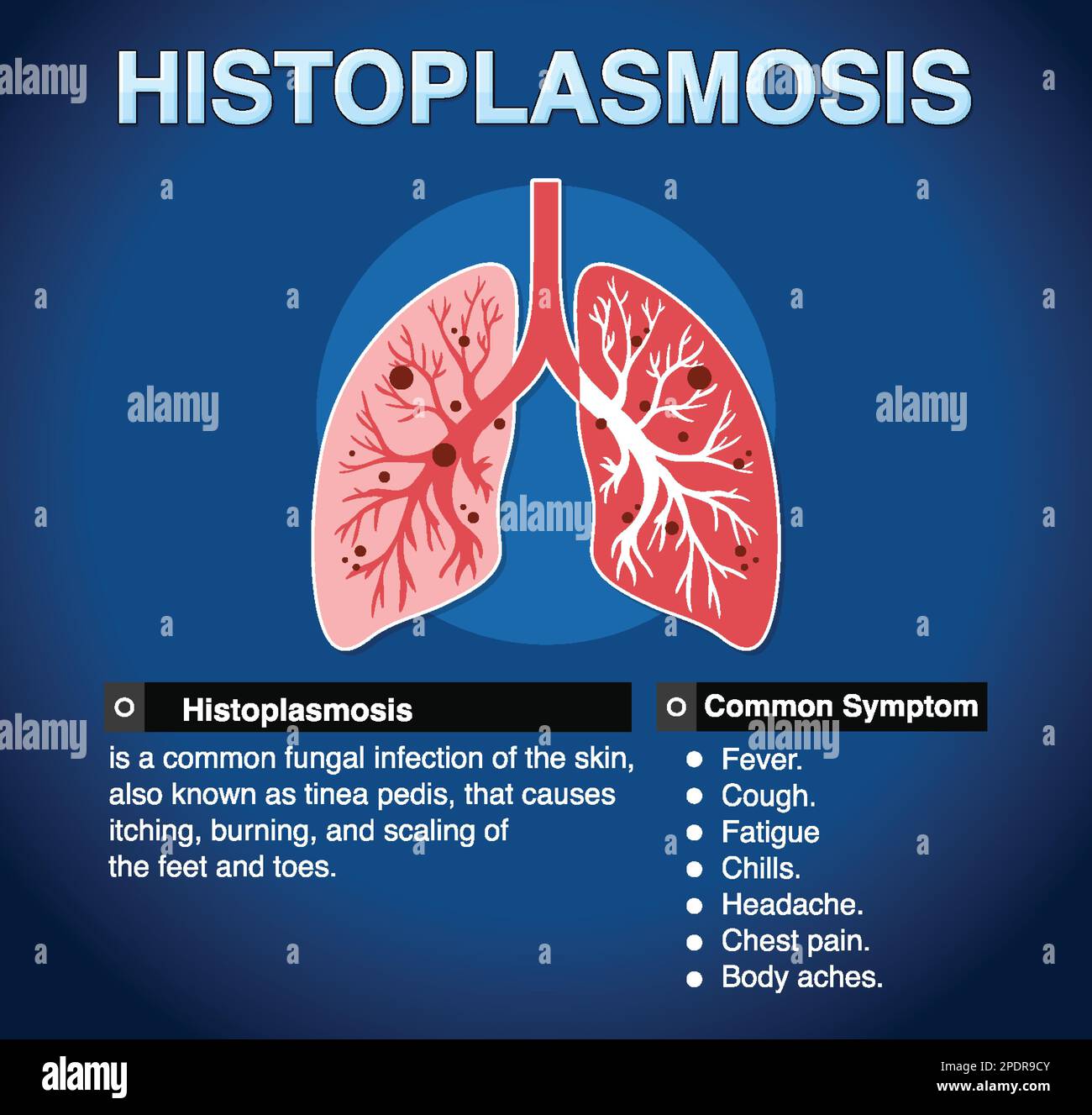 Histoplasmosis Symptoms