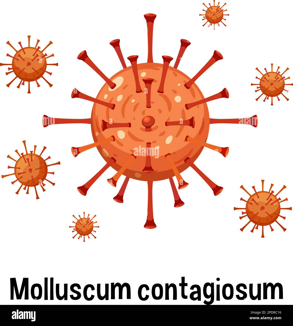 Molluscum contagiosum with text illustration Stock Vector Image & Art ...
