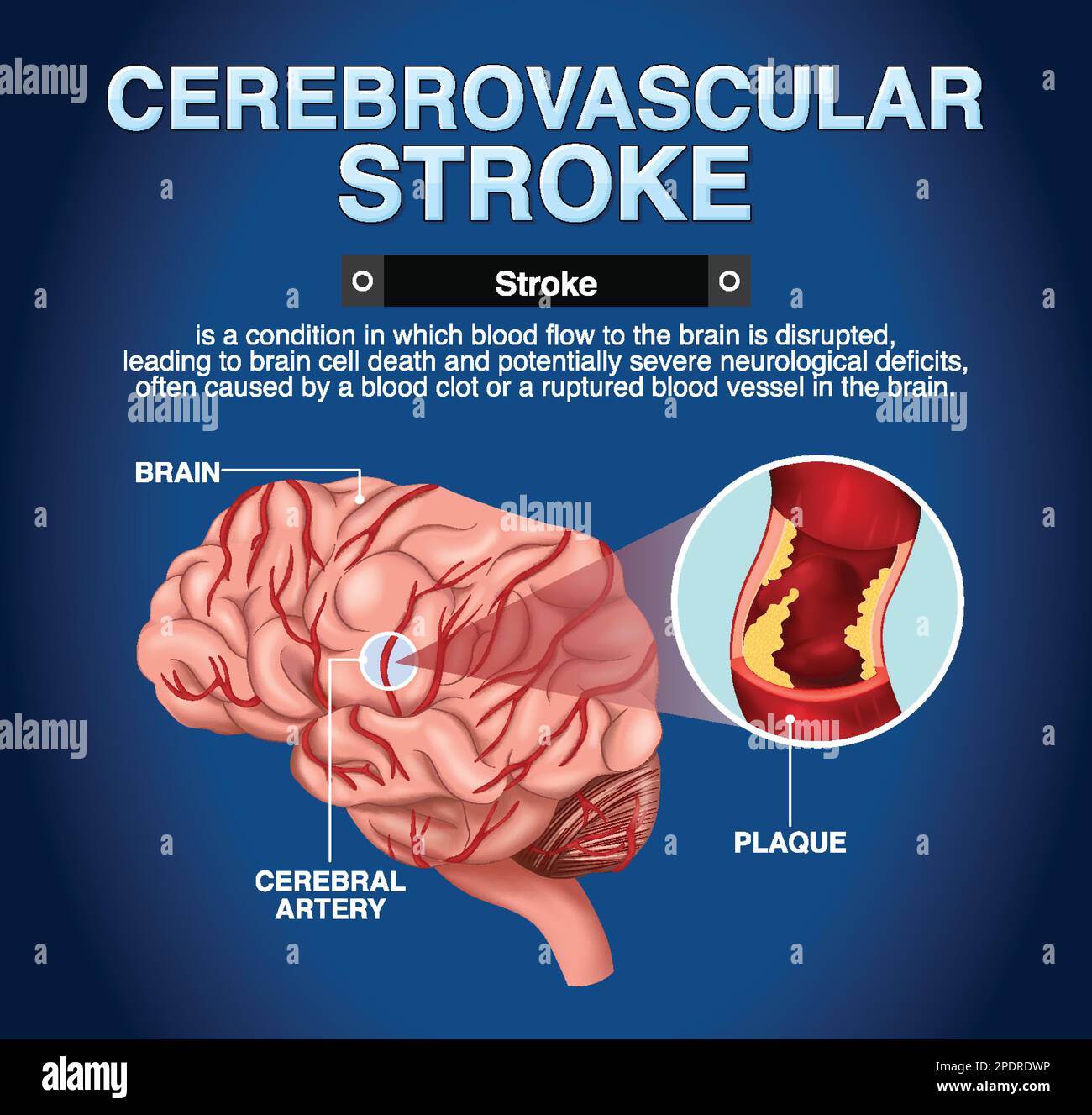Informative poster of Cerebrovascular stroke05 illustration Stock ...