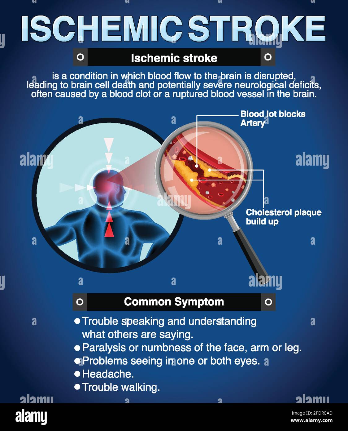 Informative poster of Ischemic stroke illustration Stock Vector Image ...
