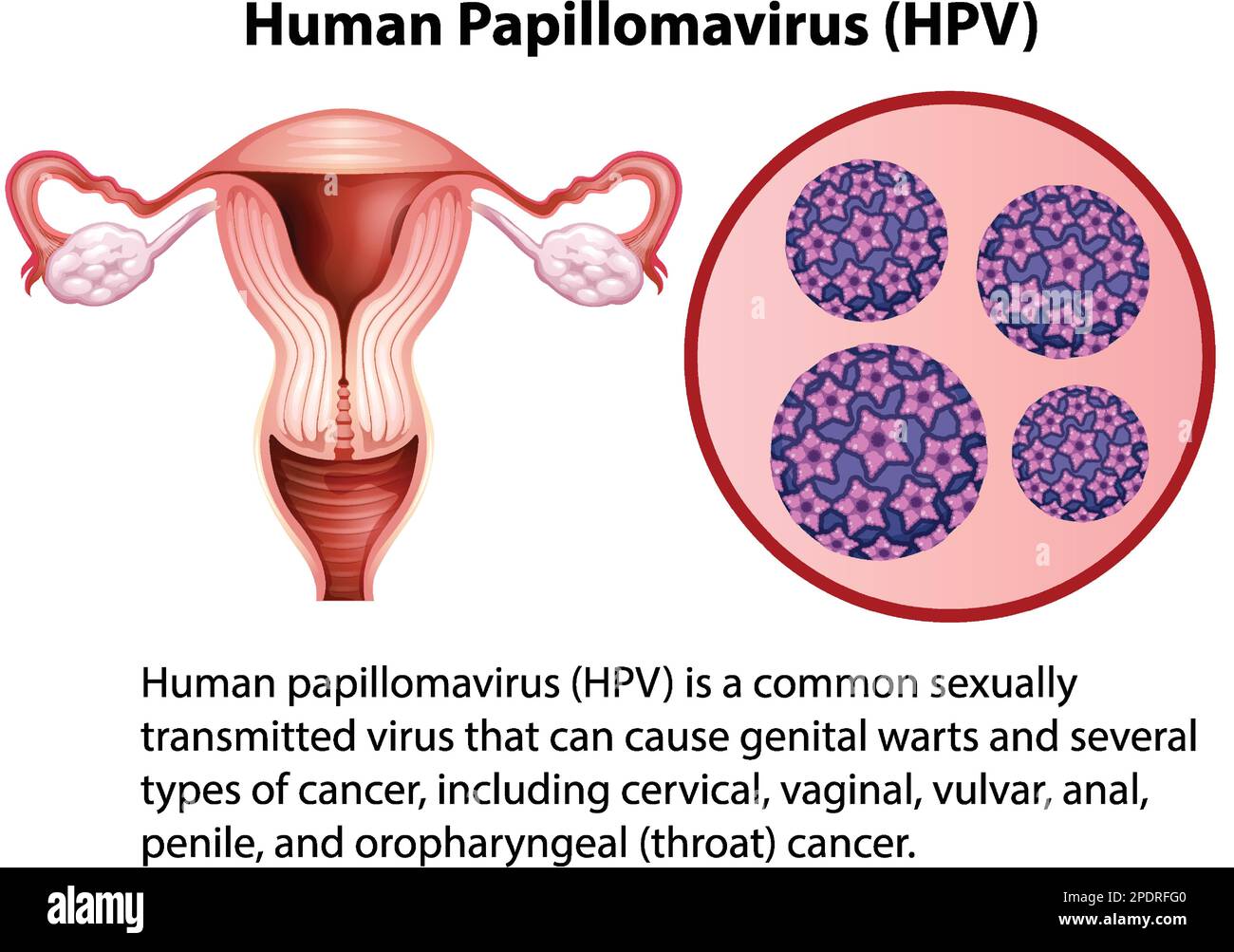 Human Papillomavirus with explanation illustration Stock Vector Image & Art - Alamy