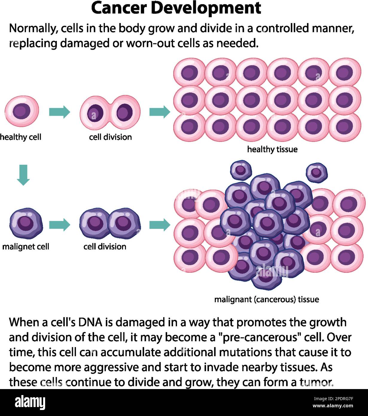 Cancer Development vector with information illustration Stock Vector ...