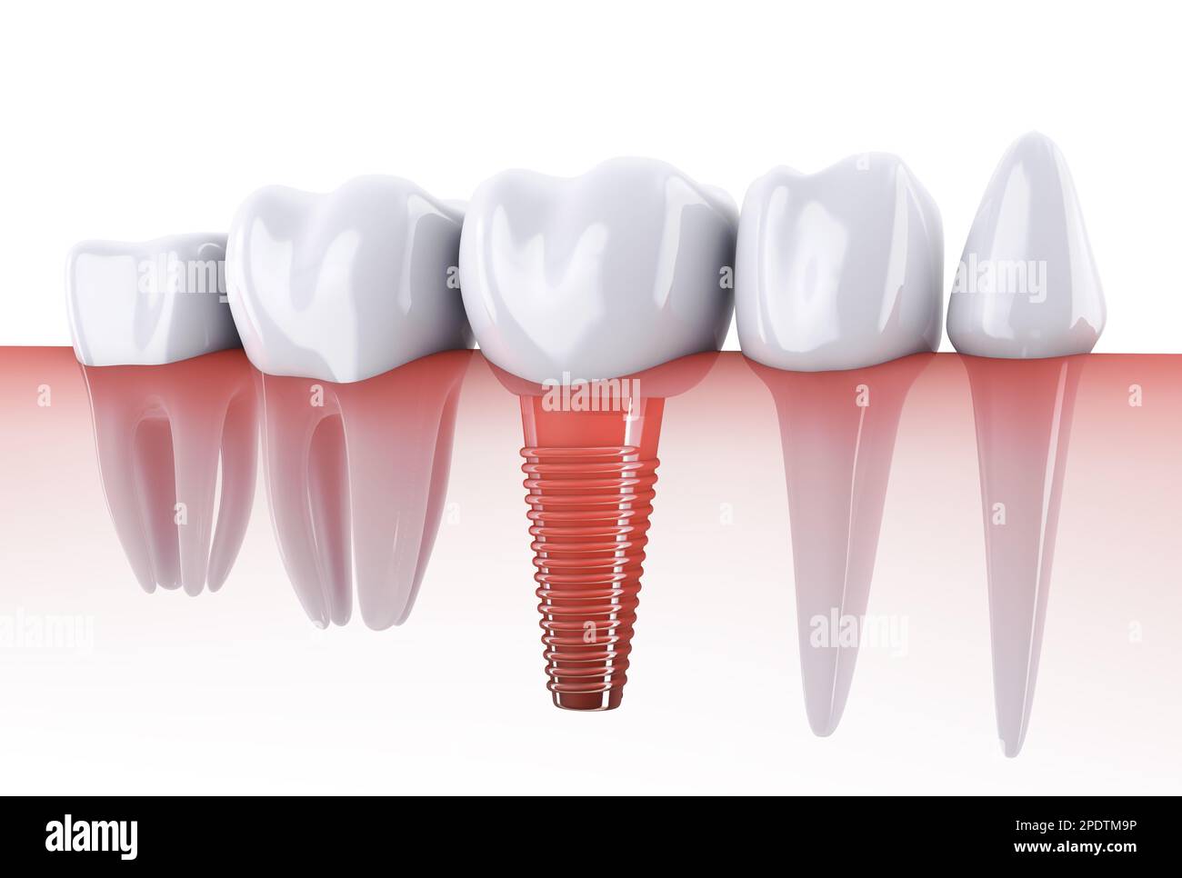 Molars and implant in the jaw bone. 3d render Stock Photo - Alamy