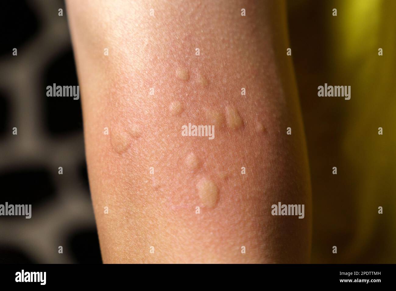 Skin texture, allergy shot, weeds, reaction Allergy symptoms Selective ...