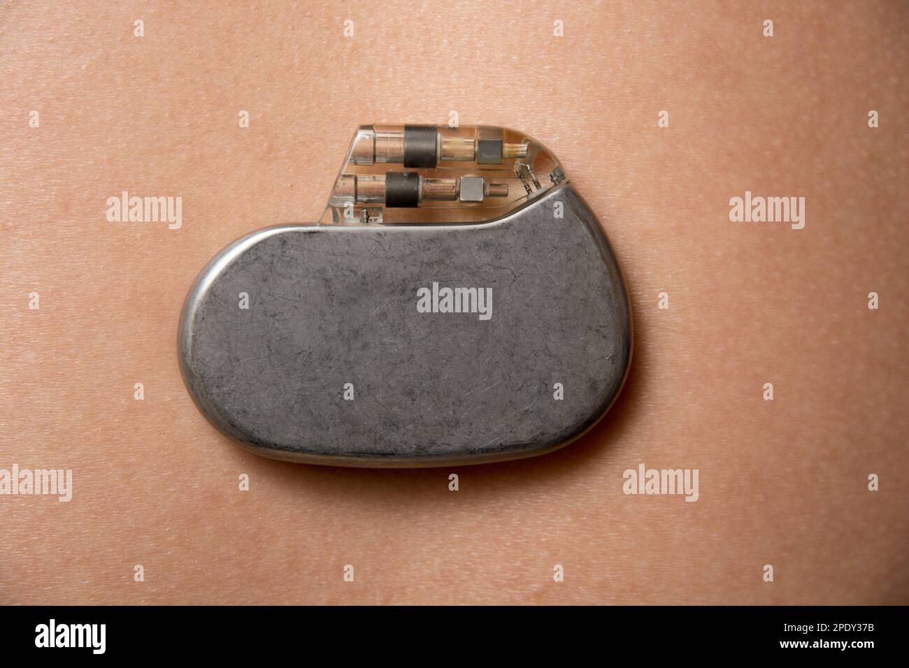 pacemaker on the skin surface Stock Photo - Alamy