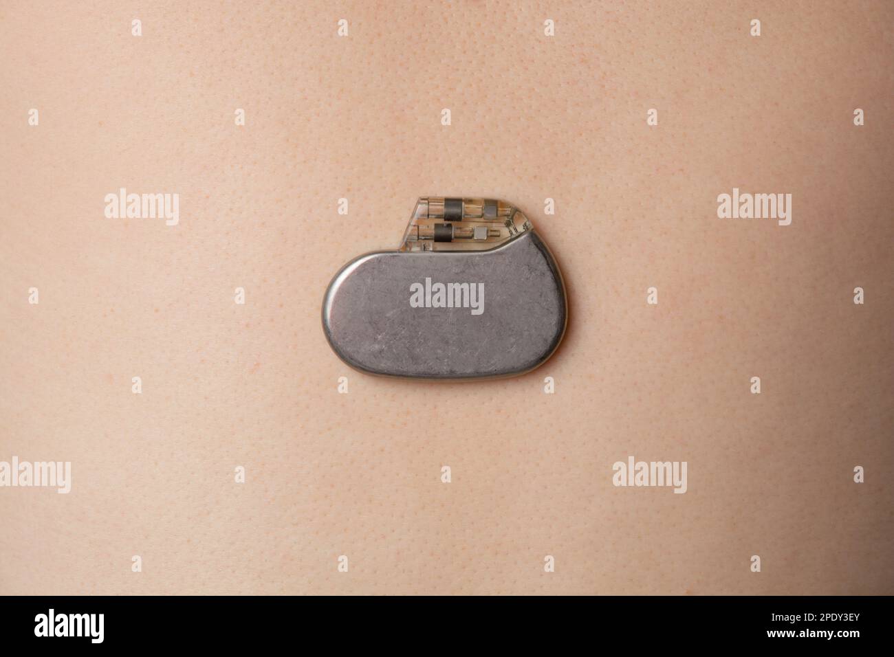 pacemaker on the skin surface Stock Photo - Alamy