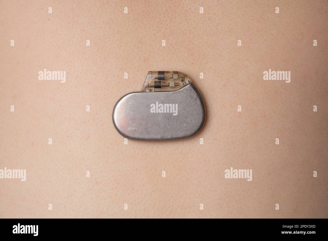 pacemaker on the skin surface Stock Photo - Alamy