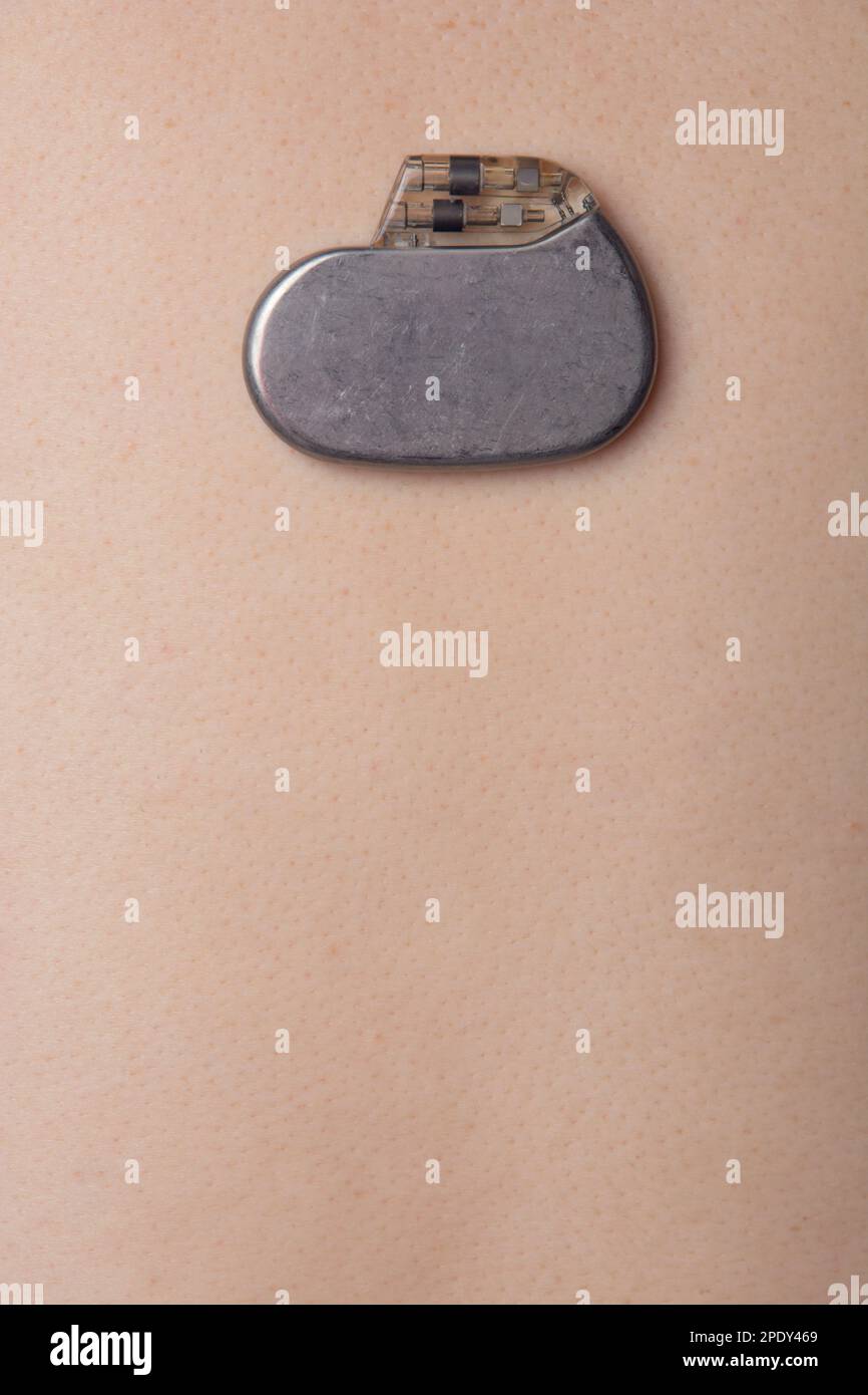pacemaker on the skin surface Stock Photo - Alamy