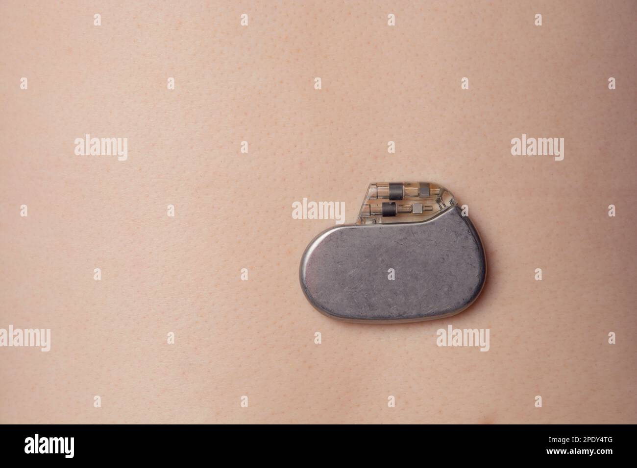 Pacemaker hi-res stock photography and images - Alamy