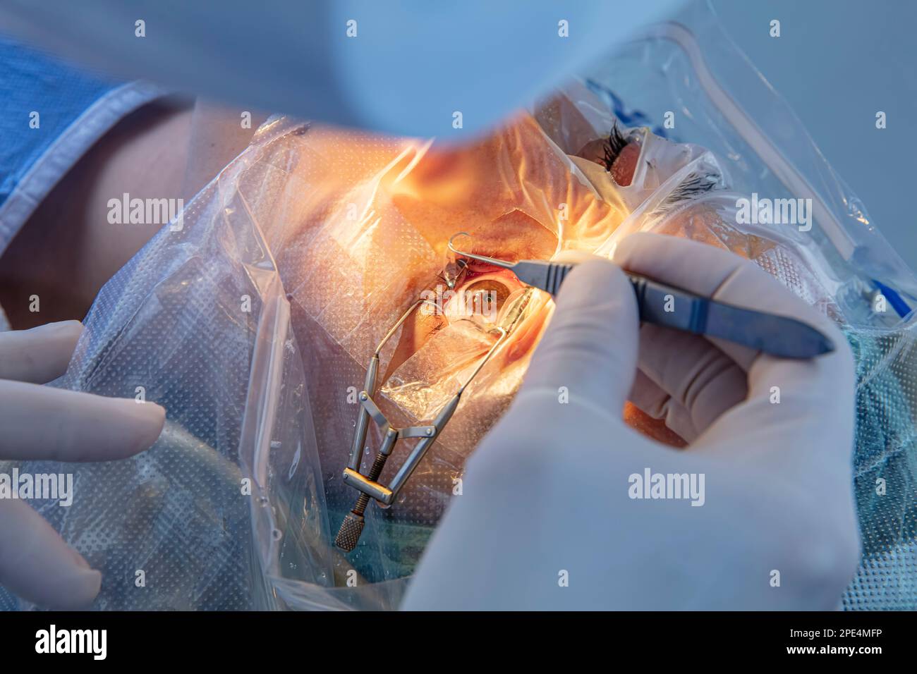 Laser vision correction. A patient and team of surgeons in the ...
