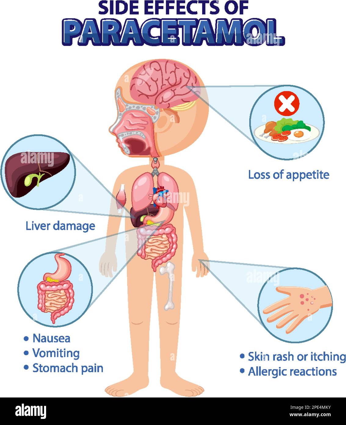 Human anatomy diagram cartoon style of paracetamol side effects ...