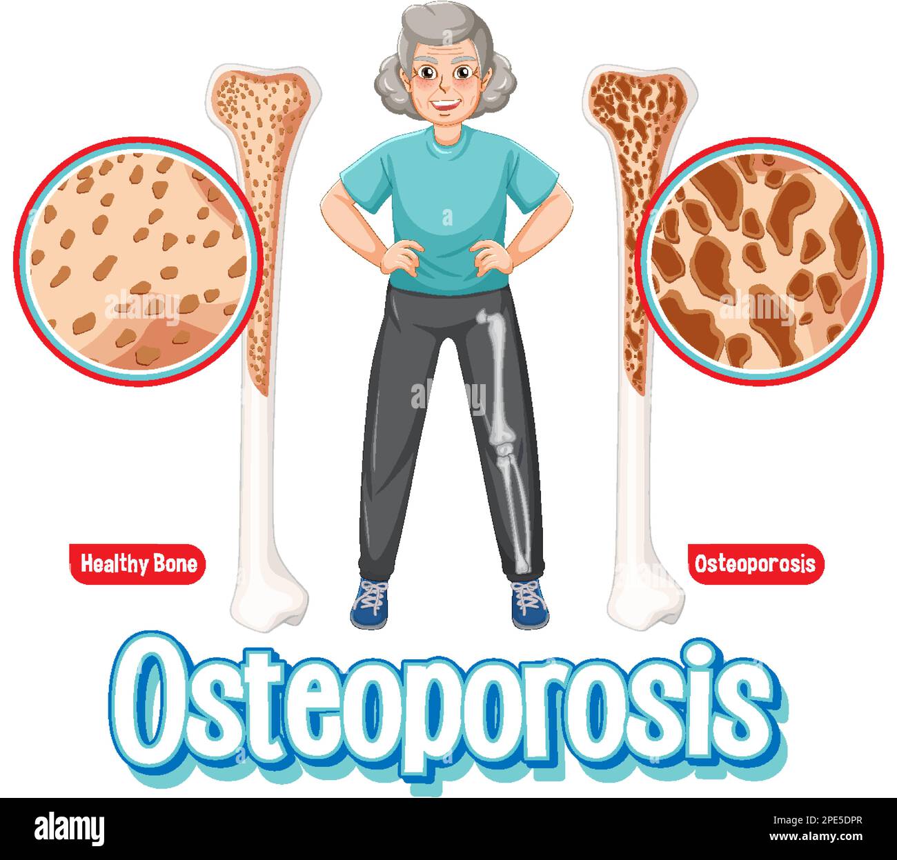 Comparison of normal bone and bone with Osteoporosis in old people ...
