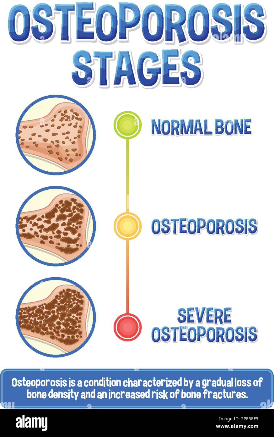 Informative poster of Osteoporosis human bone illustration Stock Vector ...
