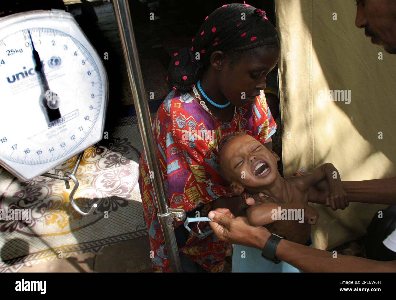 Picture released by UNICEF shows a malnourished child being prepared to ...