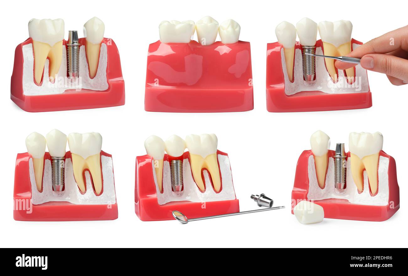 Educational models of gum with dental implant between teeth on white ...