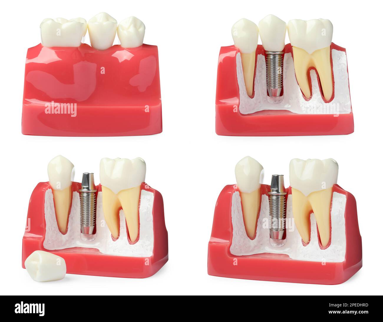 Educational models of gum with dental implant between teeth on white ...