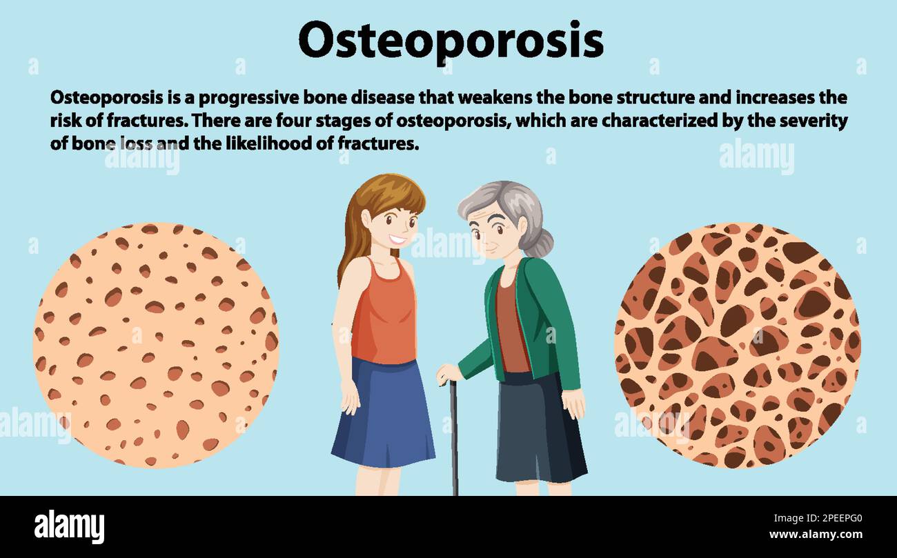 Bone Density and Osteoporosis Vector illustration Stock Vector Image ...