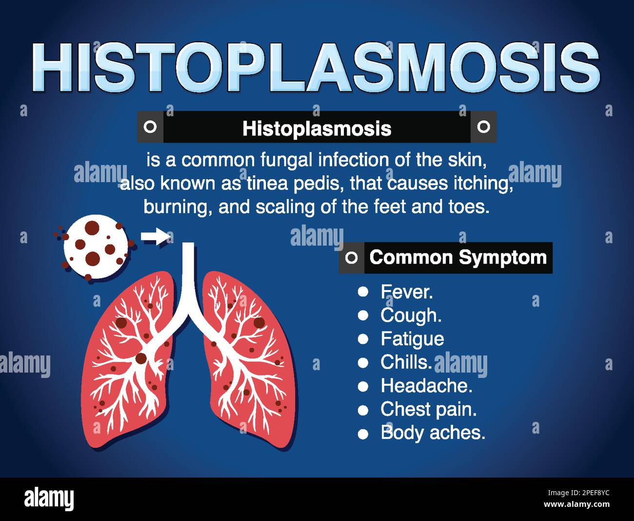 Informative poster of Histoplasmosis illustration Stock Vector Image ...