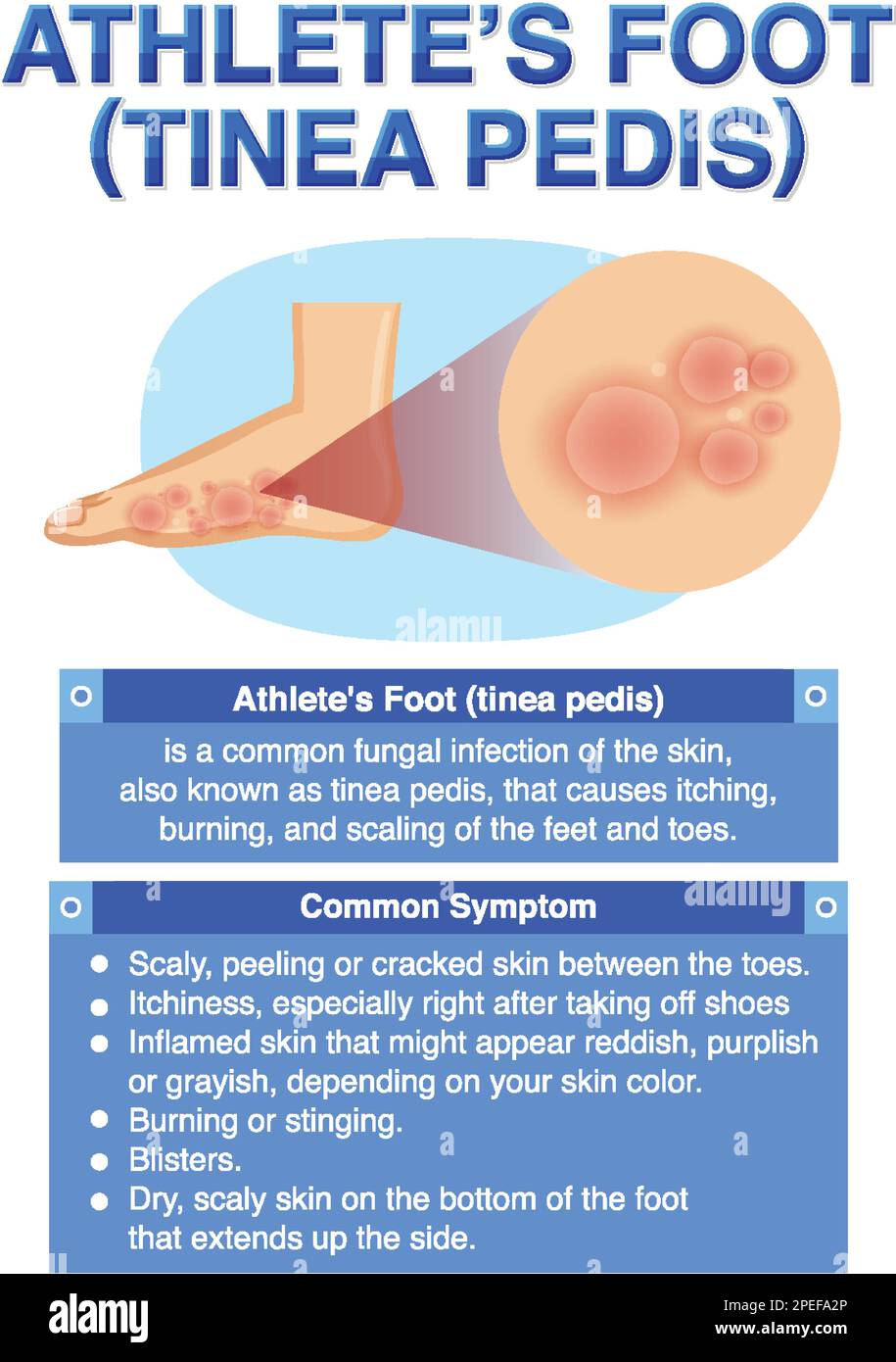 Informative poster of Athlete foot illustration Stock Vector Image ...