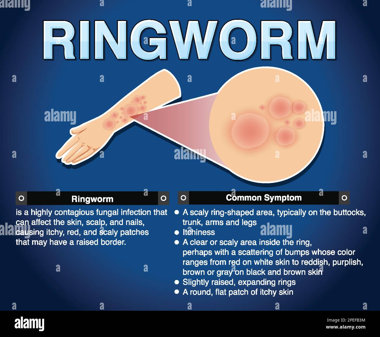 Informative poster of ringworm illustration Stock Vector Image & Art ...