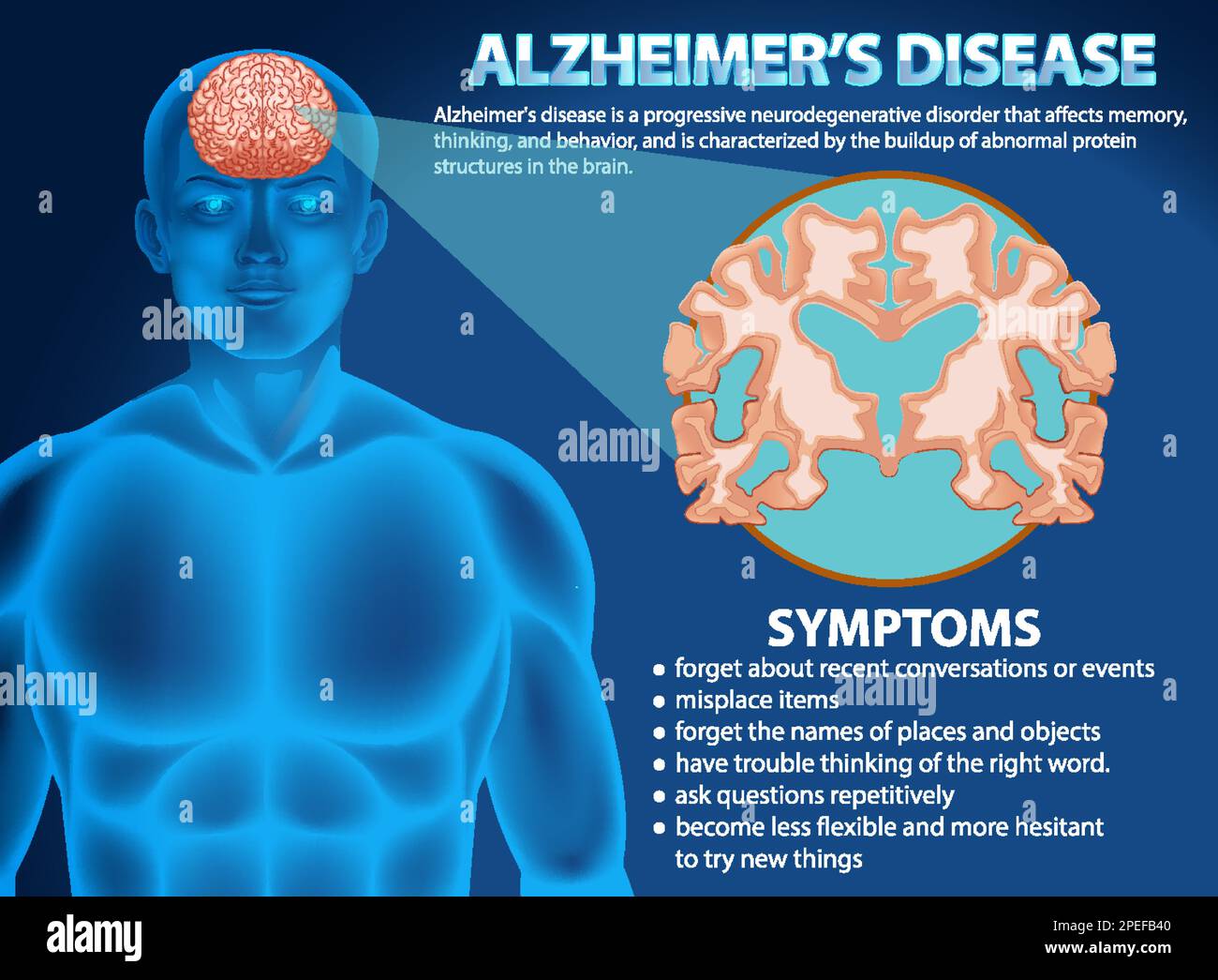 Informative poster of Alzheimers disease illustration Stock Vector ...