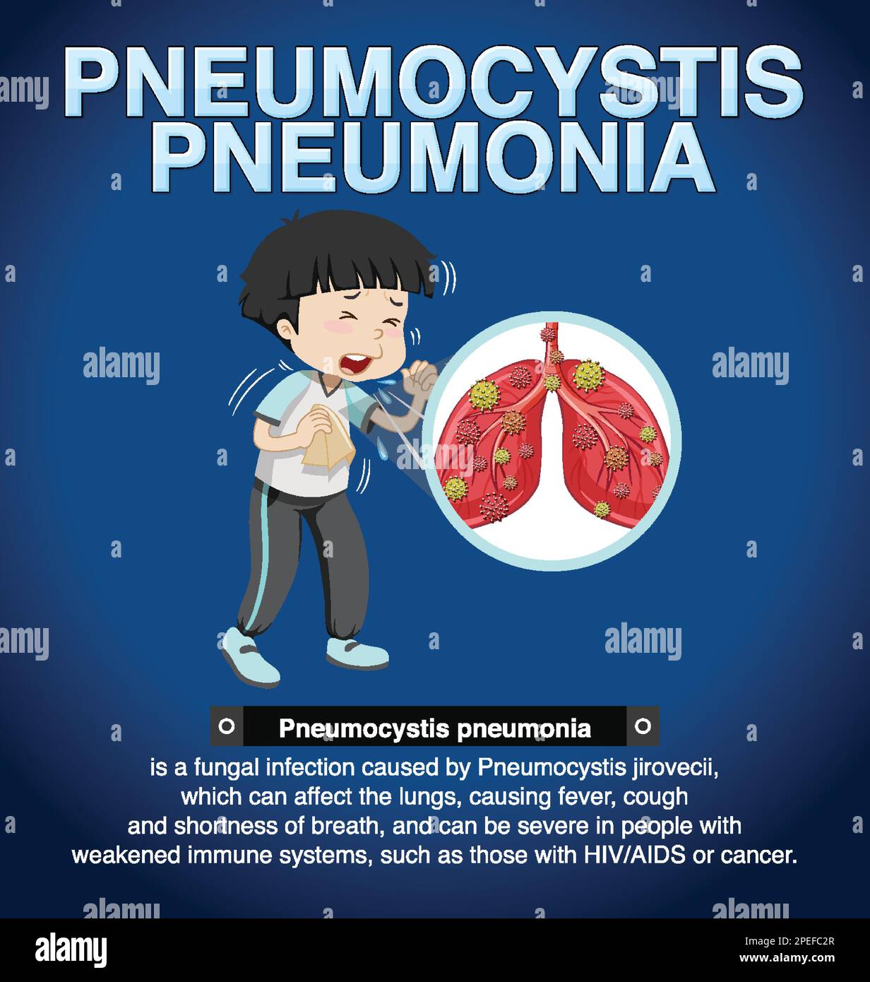 Informative poster of Pneumocystis Pneumonia illustration Stock Vector ...