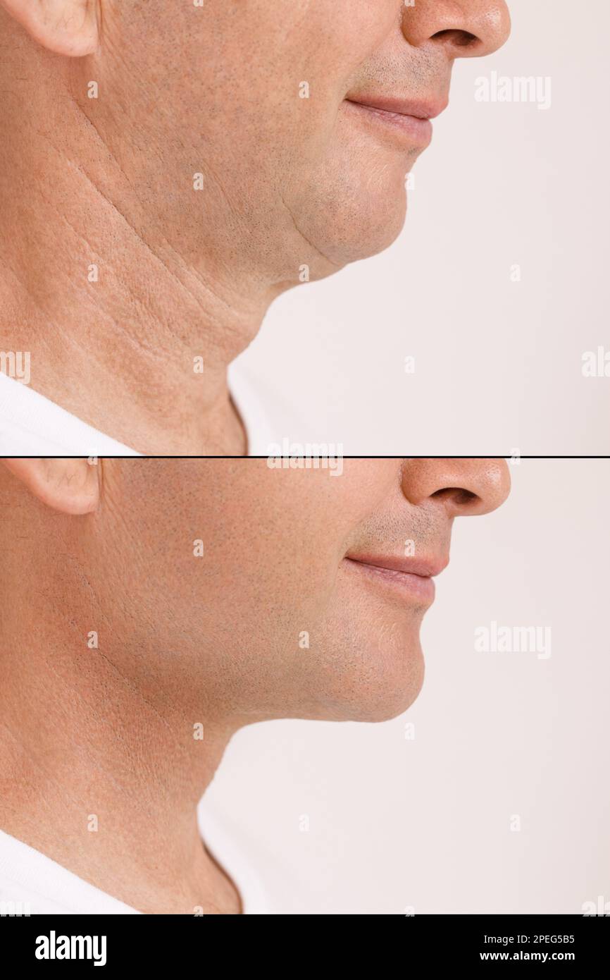 A close portrait of an aged man before and after the facial ...