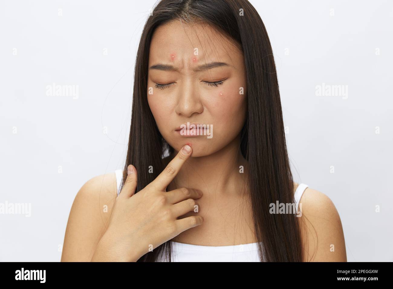 Asian woman facial skin problems, acne and inflammation, red rashes and ...