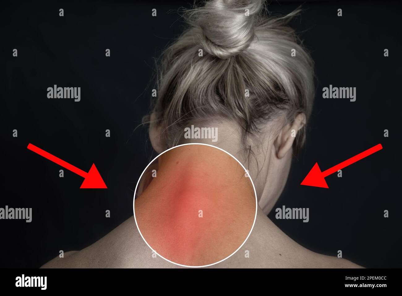 The head and neck of a girl with a highlighted place on the neck in red ...