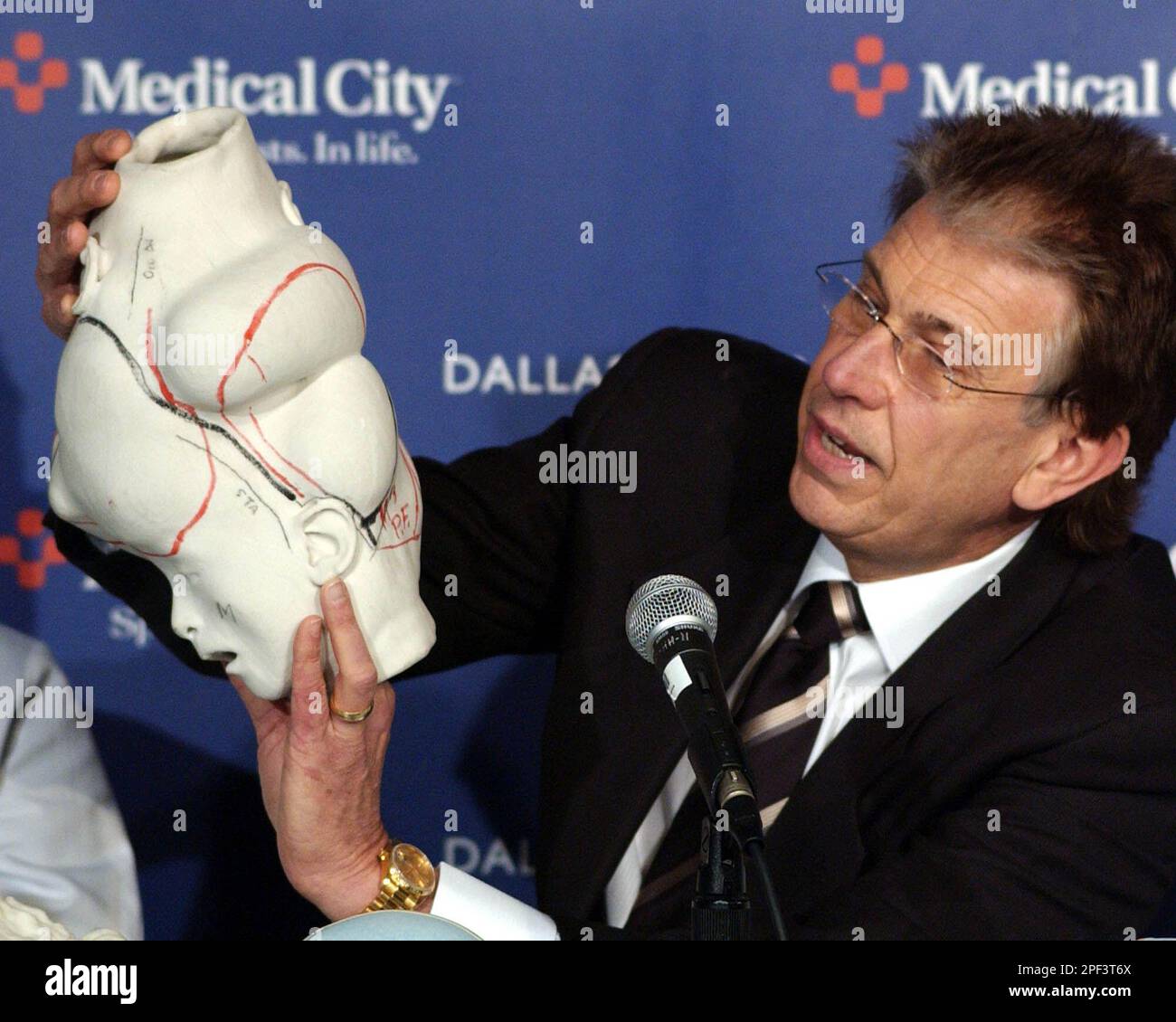 Dr. Kenneth E. Salyer holds a model of the former conjoined Egyptian ...