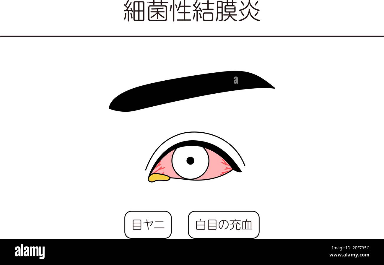 Medical Clipart, Line Drawing Illustration of Eye Disease and Bacterial ...