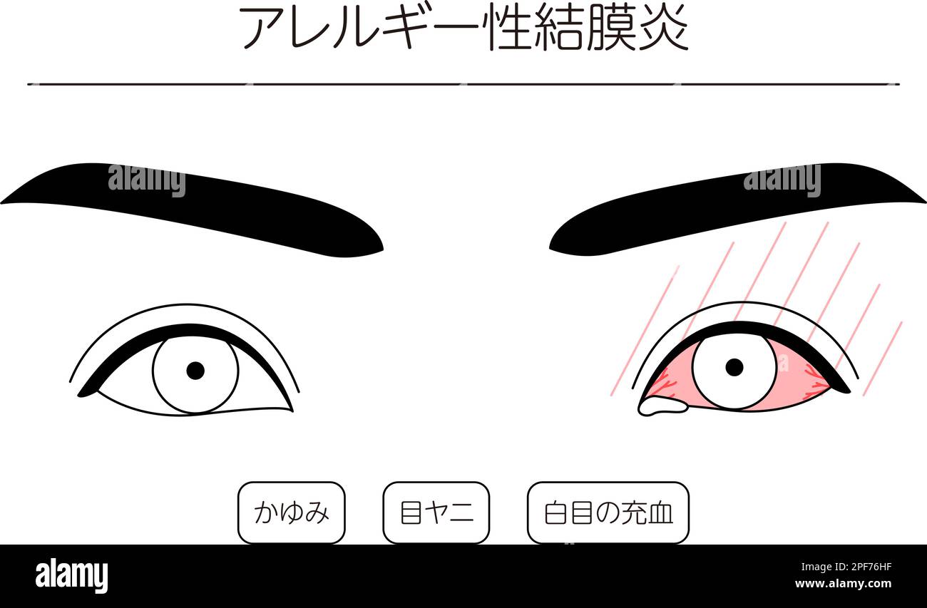 Medical Clipart, Line Drawing Illustration of Eye Disease and Allergic ...