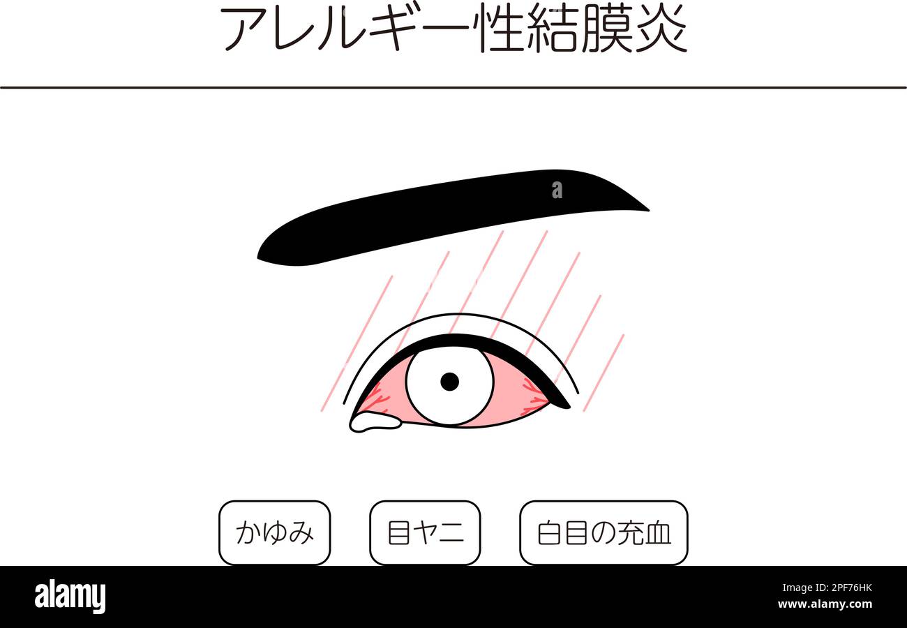 Medical Clipart, Line Drawing Illustration of Eye Disease and Allergic ...