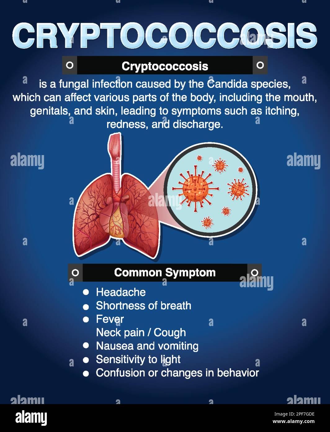 Informative poster of Cryptococcosis illustration Stock Vector Image ...