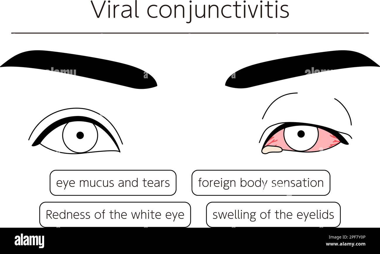 Medical Clipart, Line Drawing Illustration of Eye Disease and Viral conjunctivitis, Vector ...