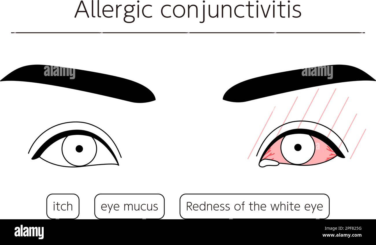 Medical Clipart, Line Drawing Illustration of Eye Disease and Allergic ...