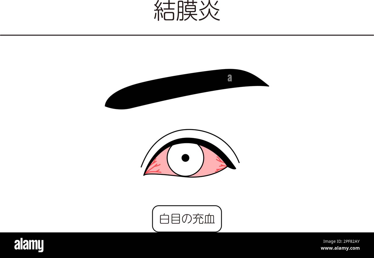 Medical Clipart, Line Drawing Illustration of Eye Disease and ...