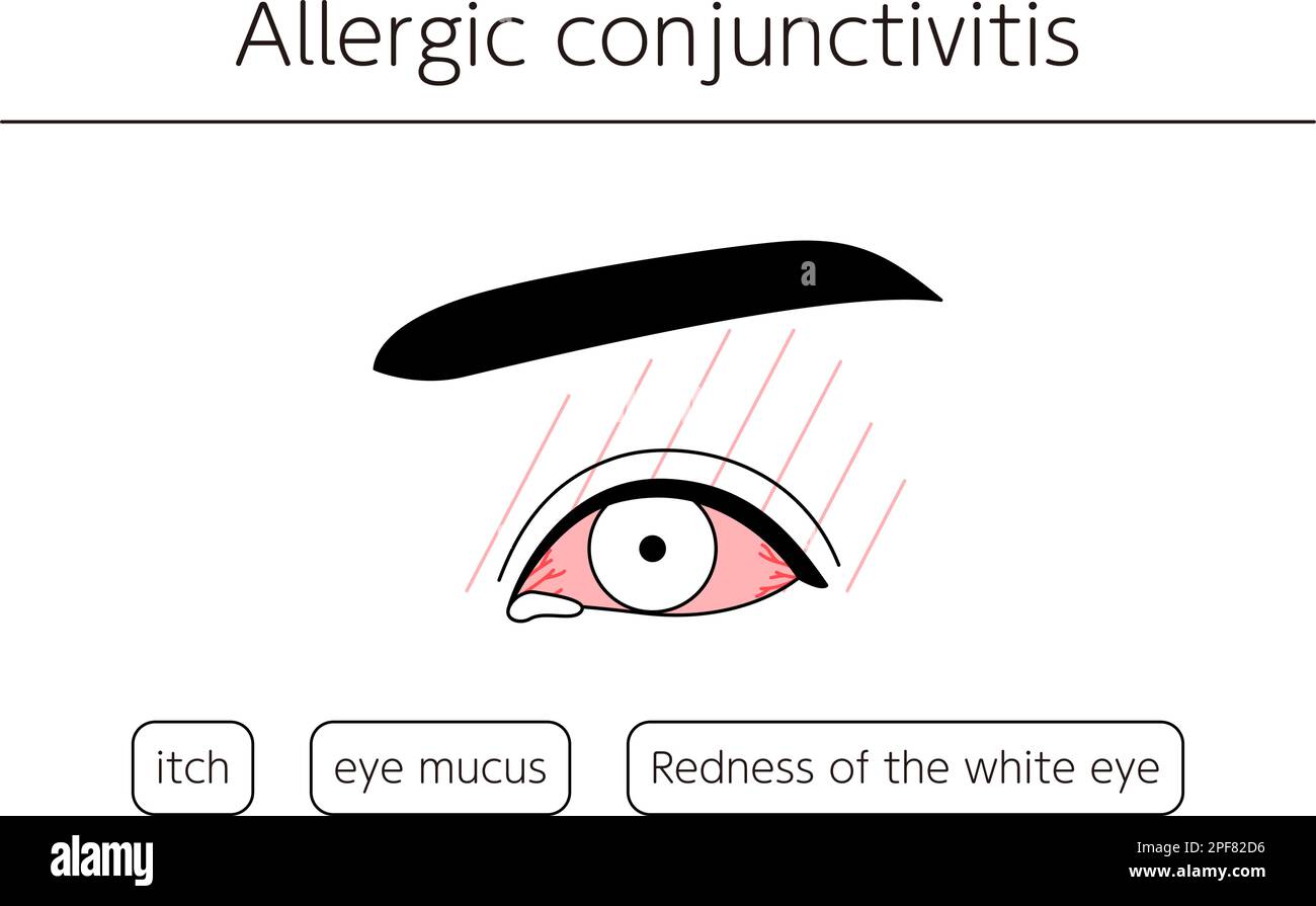 Medical Clipart, Line Drawing Illustration of Eye Disease and Allergic ...