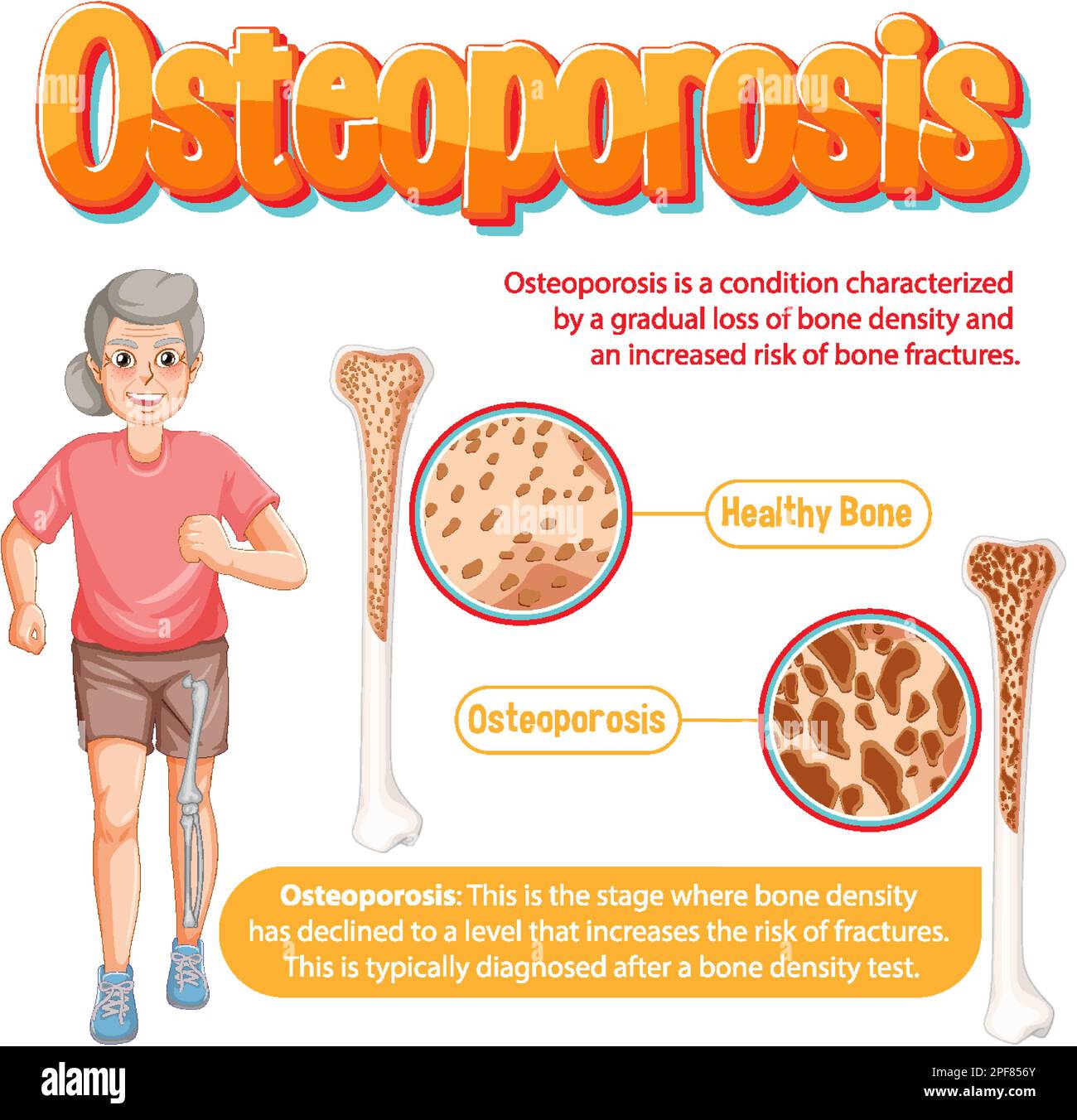 Informative poster of Osteoporosis human bone illustration Stock Vector ...