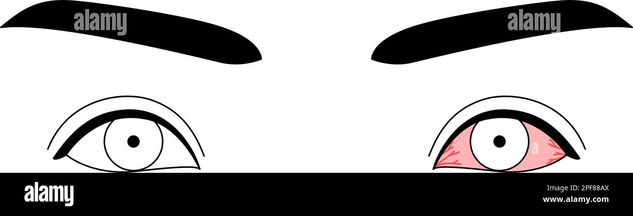 Medical Clipart, Line Drawing Illustration of Eye Disease and ...