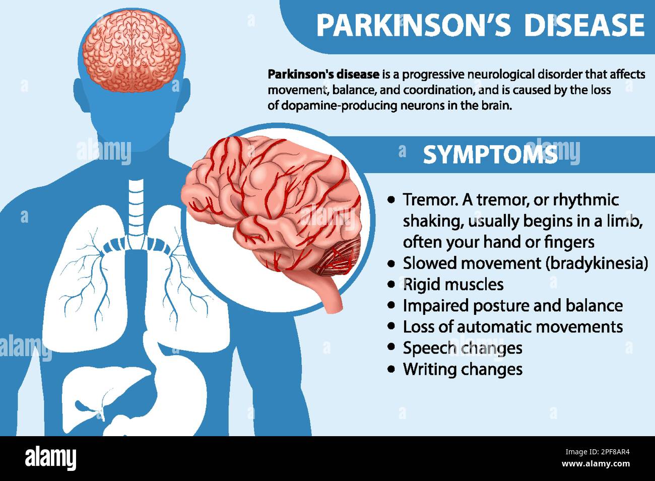 Informative poster of Parkinson disease illustration Stock Vector Image ...