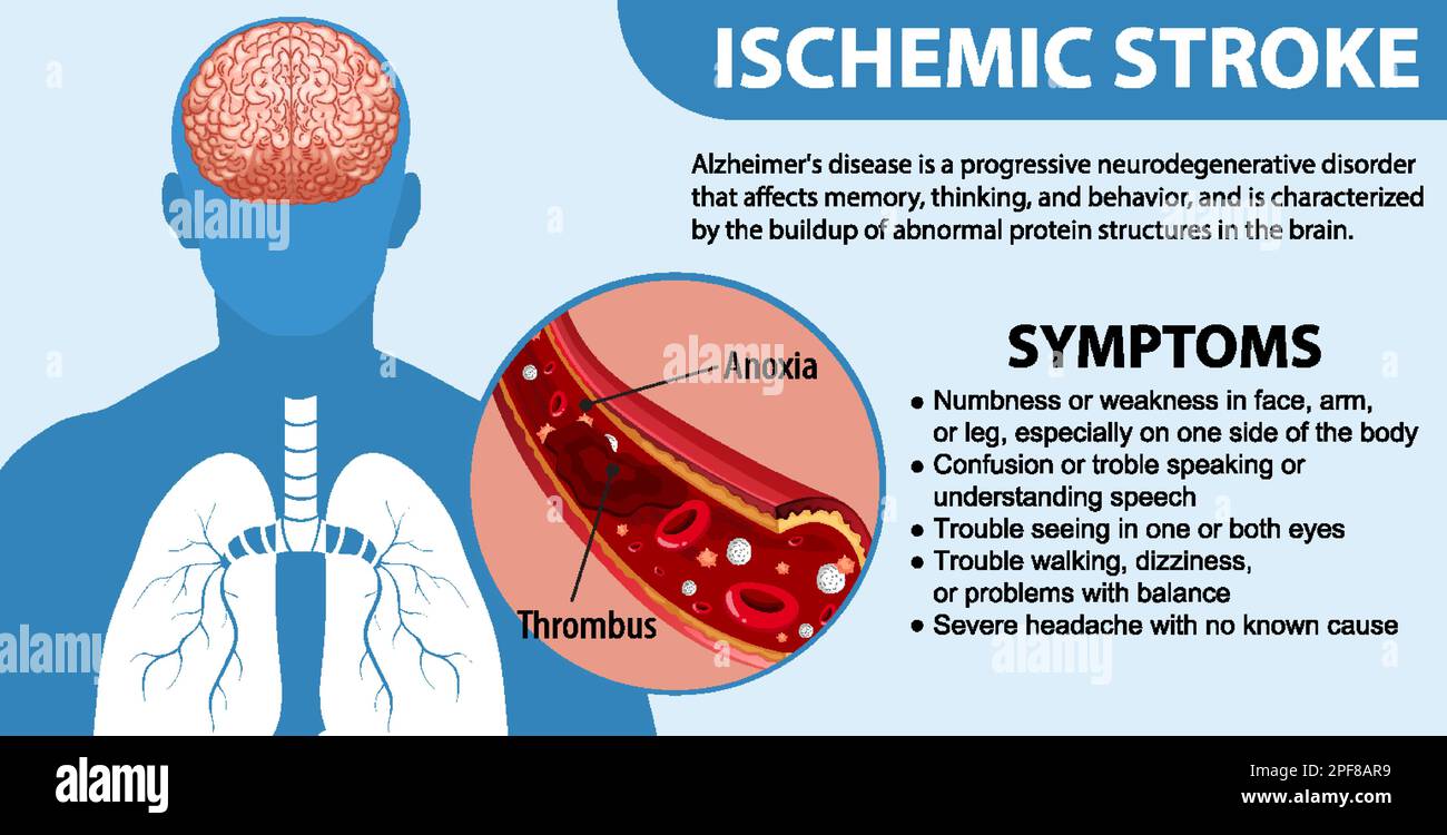 Informative poster of Ischemic stroke illustration Stock Vector Image ...